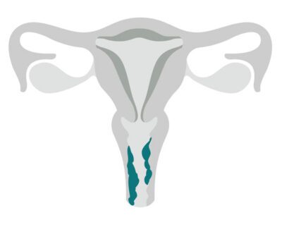 Vaginal Cancer | Foundation For Women's Cancer
